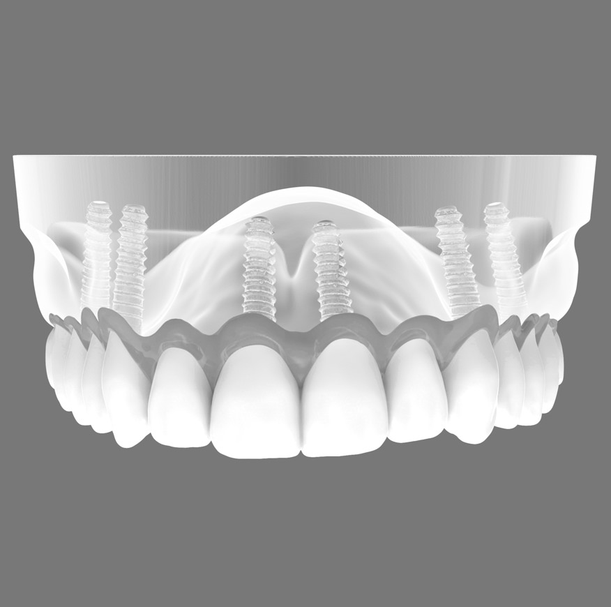 Prothèse sur implants – Centre Dentaire Bois-des-Filion | Dentistes